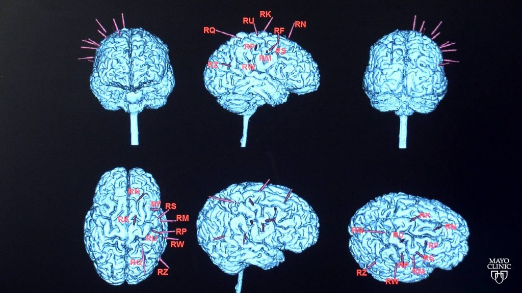 Concienciación sobre la epilepsia y el trastorno convulsivo